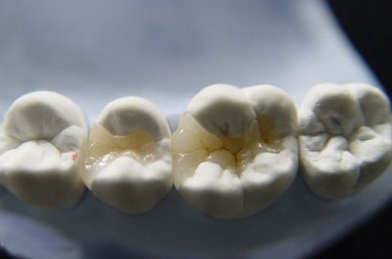 Dental Veneers Composite Inlays And Onlays For Tooth Surface Damage Repair