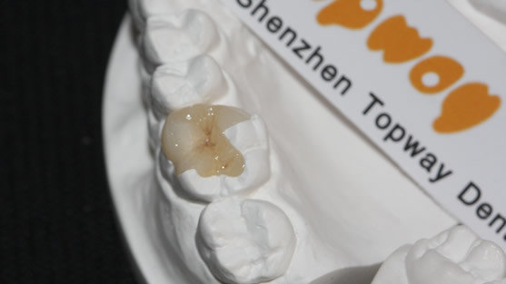 0.6MM Composite Dental Teeth Veneers Inlays And Onlays Natural Looking FDA Approved