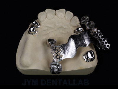 Precision Attachment Removable Partial Denture Telescope Crowns For Dental Lab