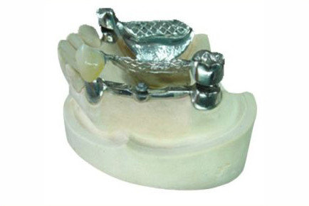 Vitallium Material Dental Precision Attachments , Telescopic Overdenture