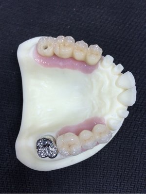 Full Ceramic Single Tooth Dental Implant Crown Tooth Bridge Durable High Strength