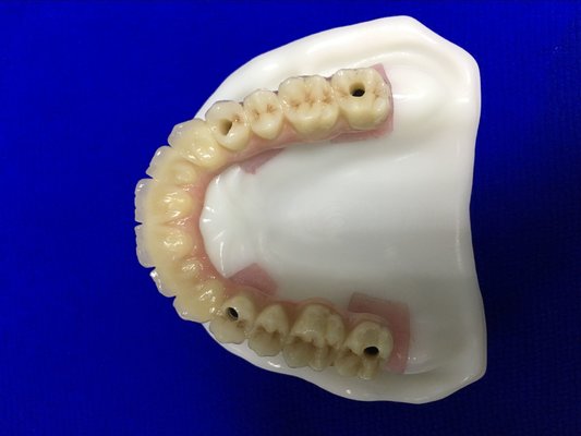 Dental Lab All Zirconia Dental Implant Crown Teeth Bridge Minimally Invasive