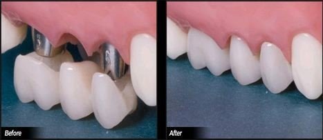 Metal Dental Crowns And Bridges For Tooth Replacement Corrosion Resistant