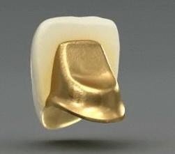 Dental Crown Lab Captek Tooth Crown Gold Composite , Tooth Cap Highly Biocompatible