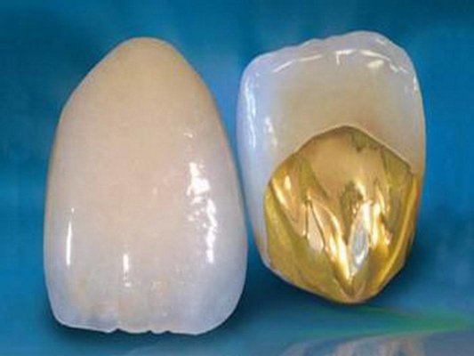 Honorable Gold Composite Captek Dental Crown Lab for Front / Back Teeth