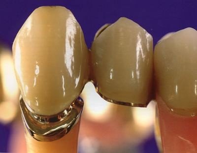Gold Composite Nanogold Captek Crown Tooth Bridge For Dental Clinic High Strength