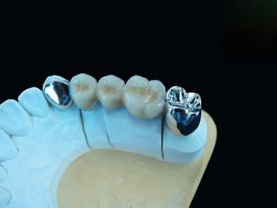 Ultra Hard Composite Dental Veneers , Health PFM Dental Crown High Intensity