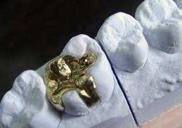 Luxury Yellow Gold Alloy Inlay Onlay Dental With Excellent Biocompatible