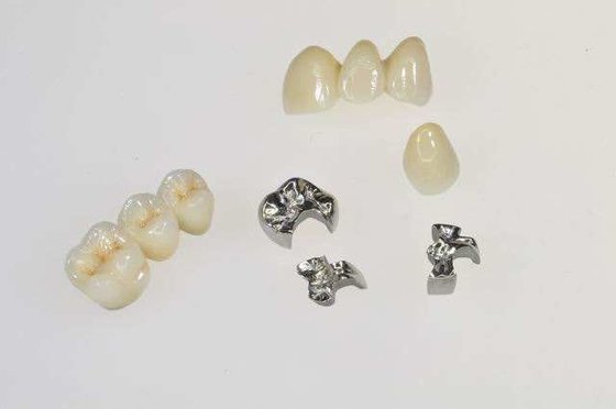 Cobalt And Chromium Alloy Strong Inlays And Onlays In Dentistry For Teeth