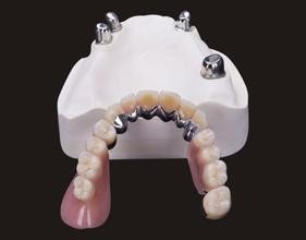 Removable Metal Dental Precision Attachments , Telescopic Dentures And Bridges