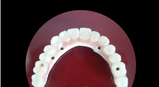 Dental Peek Optima BIO HPP Crowns Perfect Prosthesis Permanent FDA Approved