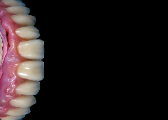 Dental Prosthesis Peek Optima BIO HPP Crowns And Bridges Good Hardness