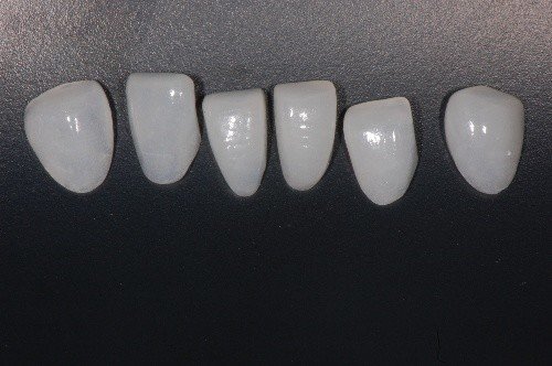 Efficient Composite Resin Dental Front Teeth Veneers , 0.5MM Teeth Whitening Veneers