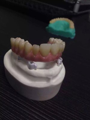 Professional Dental Hader Bar Attachments High Precision High Retention