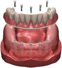Hybrid Bar Attachment Metal Based Dentures For Screwed Retained Defects Implants