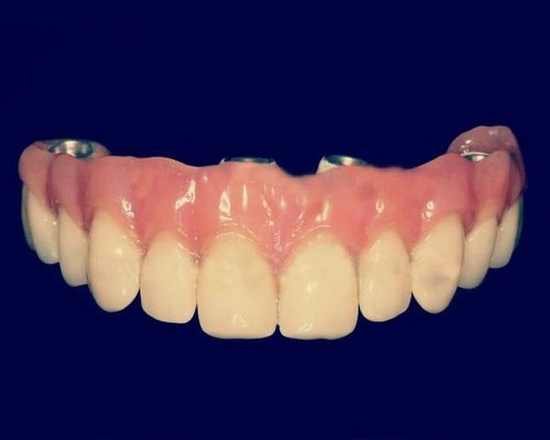 Titanium Hader Bar Attachments Metal Based Dentures For Comestic Defects Implants