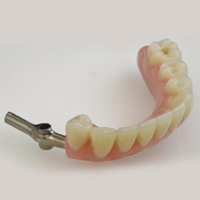 Acrylic Screw Retained Hybrid All On 4 Dentures For Fully Edentulous Patient