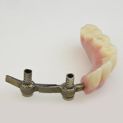 Provisional All On 4 Dentures With Rigid Cross Arch Implant Supported
