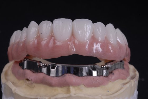 High Retention Hader Bar Attachments , Dental Locator Implant Attachments