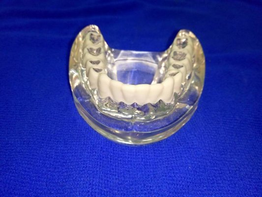 Comforatable Snap on Snap With Germany Dentaurum Resin Material
