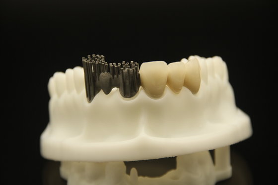Dental Laser Milled Co-Cr Metal Crowns And Bridge With 3D Printing Technology