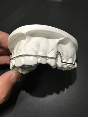 Traditional Lingual Arch Orthodontic Dental Retainer Removable To Straighten Teeth