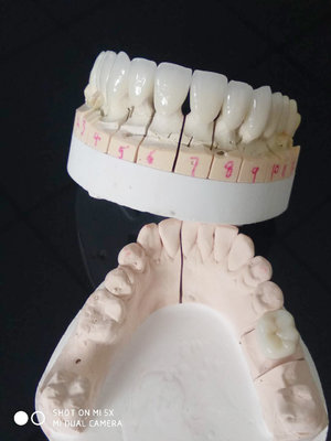 1M1 Shade Full Contoured Zirconia Crown & Bridge With FDA ISO Certificate