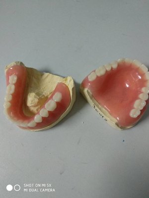 Dental Restoraton Acrylic Removable Partial Denture With Composite Teeth , Easy To Clean