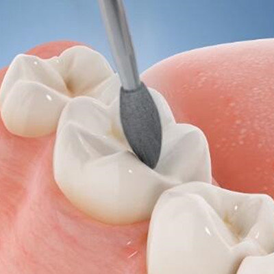 Dental Diamond Burs Dental diamond burs are used for precise drilling and polishing of critical ceramic parts