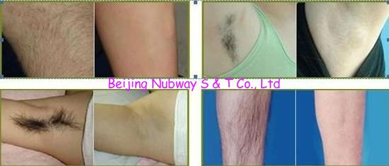 High Quality of Portable 808nm Diode Laser Hair Removal Machine Beauty Spa Hair Removal