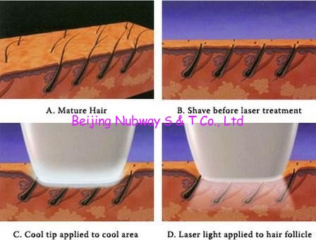 Clinic Use 808nm Diode Laser Hair Removal Machine For Permanent Unwanted Hair Reduction