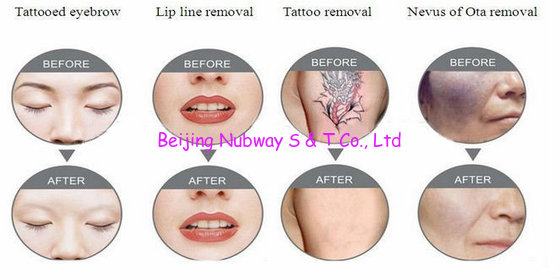 Factory Price Sales Laser Tattoo Removal Machine / Skin Rejuvenation for Beauty Salon
