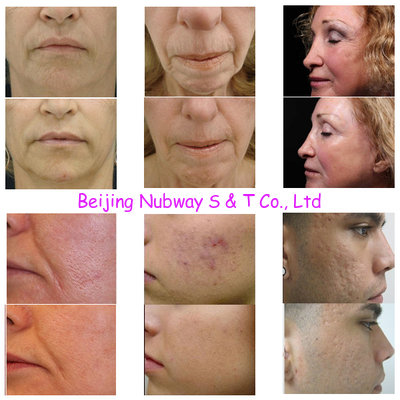 Professional CE Approved Radio Frequency Micro Needle Facial Machine for Wrinkle Removal