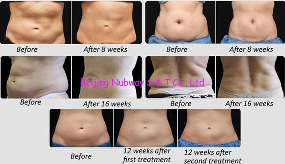 Cryolipolysis Vacuum Fat Freezing/Cellulite Removal Fat Reduction RF Ultrasound Machine