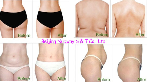 Professional Medical Fat Freeze Ultrasound Machine/ Vacuum Multipolar RF Slimming Device
