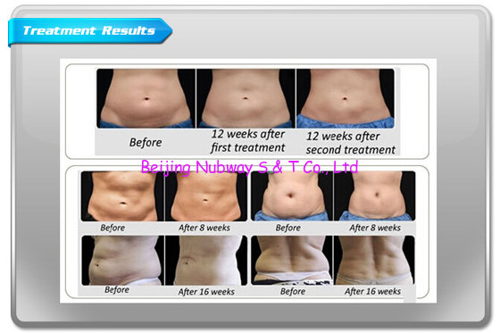China Factory Direct Sales! Nubway Portable Cryolipo Cool Fat System Cryolipolysis Machine