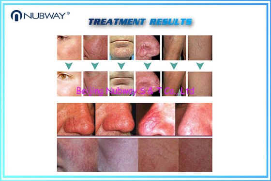 China 30Mhz High Frequency Spider Vein Vascular Removal Machine Supplier