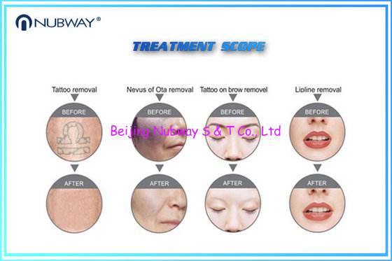Chinese Suppliers New Listing 2000Ps Pulse Width Picosecond Q Swithed Nd Yag All Skin Types Fotona 4D Tattoo Removal