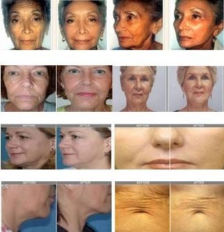 Laser technician RF Radio Frequency Skin Tightening/Lifting Machine