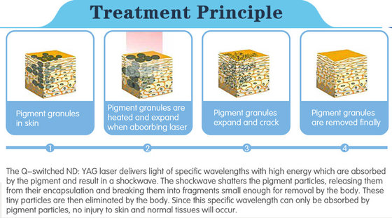 Promotion！laser skin clinic ND:Yag Laser Tattoo Removal/Skin Rejuvenation Unit NBW-1000