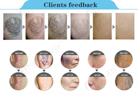Promotion！laser skin clinic ND:Yag Laser Tattoo Removal/Skin Rejuvenation Unit NBW-1000