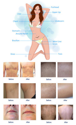 China nubway best popular medical ce approved portable 808 nm diode laser hair removal machine