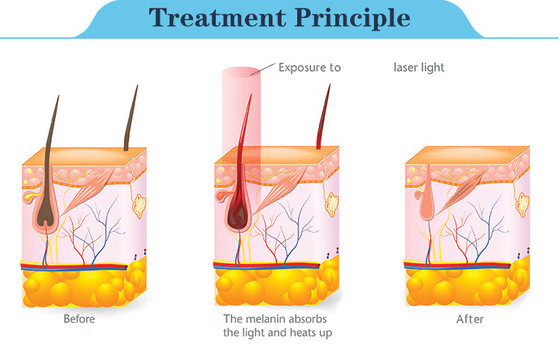 China nubway best popular medical ce approved portable 808 nm diode laser hair removal machine