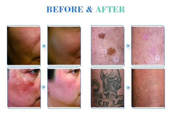 New design! laser picosecond/ laser pico sure 1064 532 tattoo machine/pigmenation removal