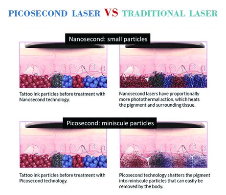 laser picosecond/ laser pico sure 1064 532 1320 755 tattoo machine/pigmenation removal