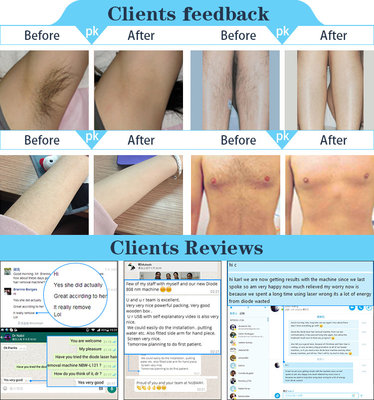 Looking for Distributor 808nm 810nm Diode Laser Permanent Hair Removal System NBW-L131