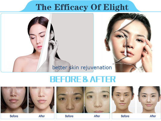 Nubway Manufacturer Two Handles IPL SHR Hair Removal/Skin Rejuvenation System NBW-SHR212