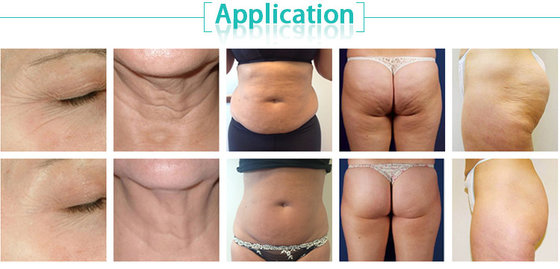 2018 Effective five handles mini cavitation rf vacuum professional slimming machine for sale