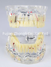 China Dental Adult Transparent Pathology Model Deletion of dental caries dental caries missing model supplier