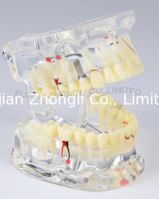 Dental Adult Transparent Pathology Model Deletion of dental caries dental caries missing model supplier